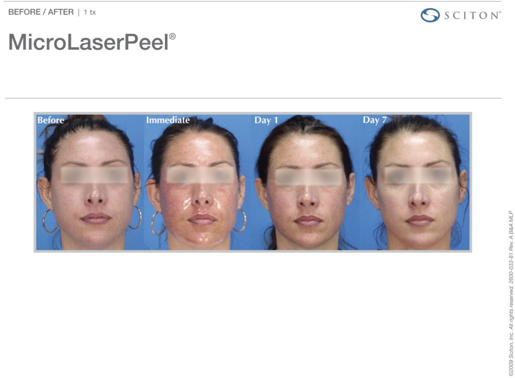 MicroLaserPeel in Beavercreek | PureMD